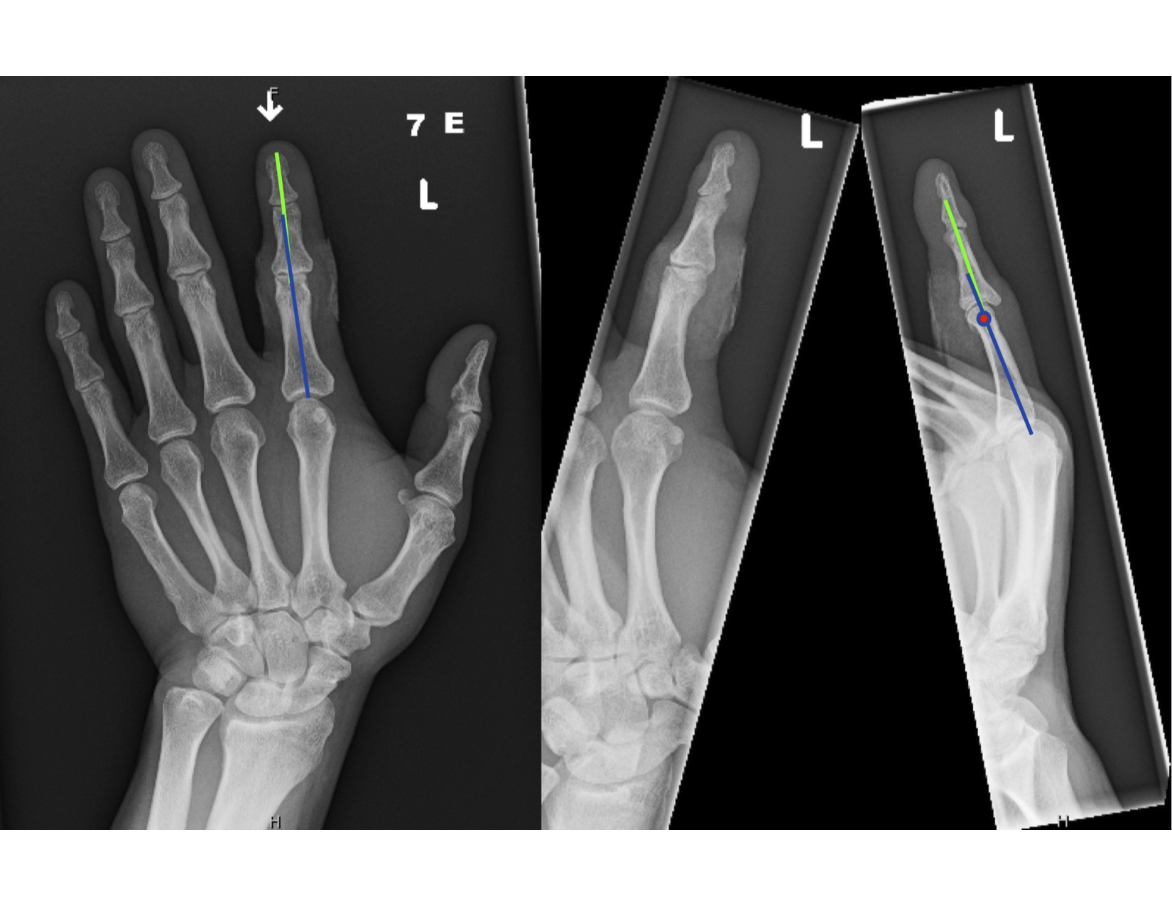 Metacarpal Anatomy Bone Metacarpal Anatomy Bone